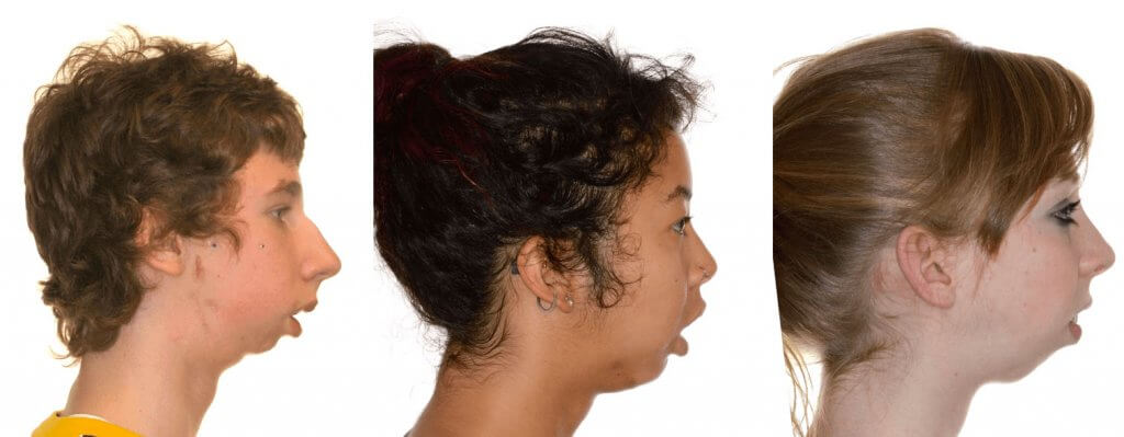 Blog | New York Center for Orthognathic & Maxillofacial Surgery