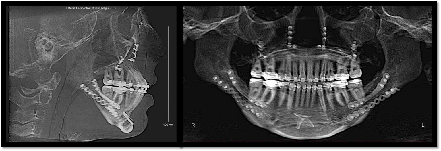 Aside From Micrognathia, What Do These Patients Have In Common?